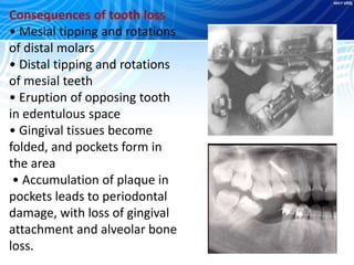 Memory Titanol Spring for Uprighting of Molar.pptx