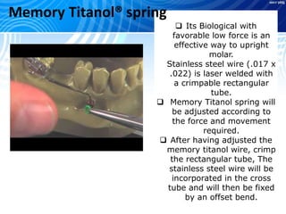 Memory Titanol Spring for Uprighting of Molar.pptx