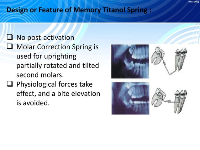 Memory Titanol Spring for Uprighting of Molar.pptx