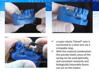 Memory Titanol Spring for Uprighting of Molar.pptx