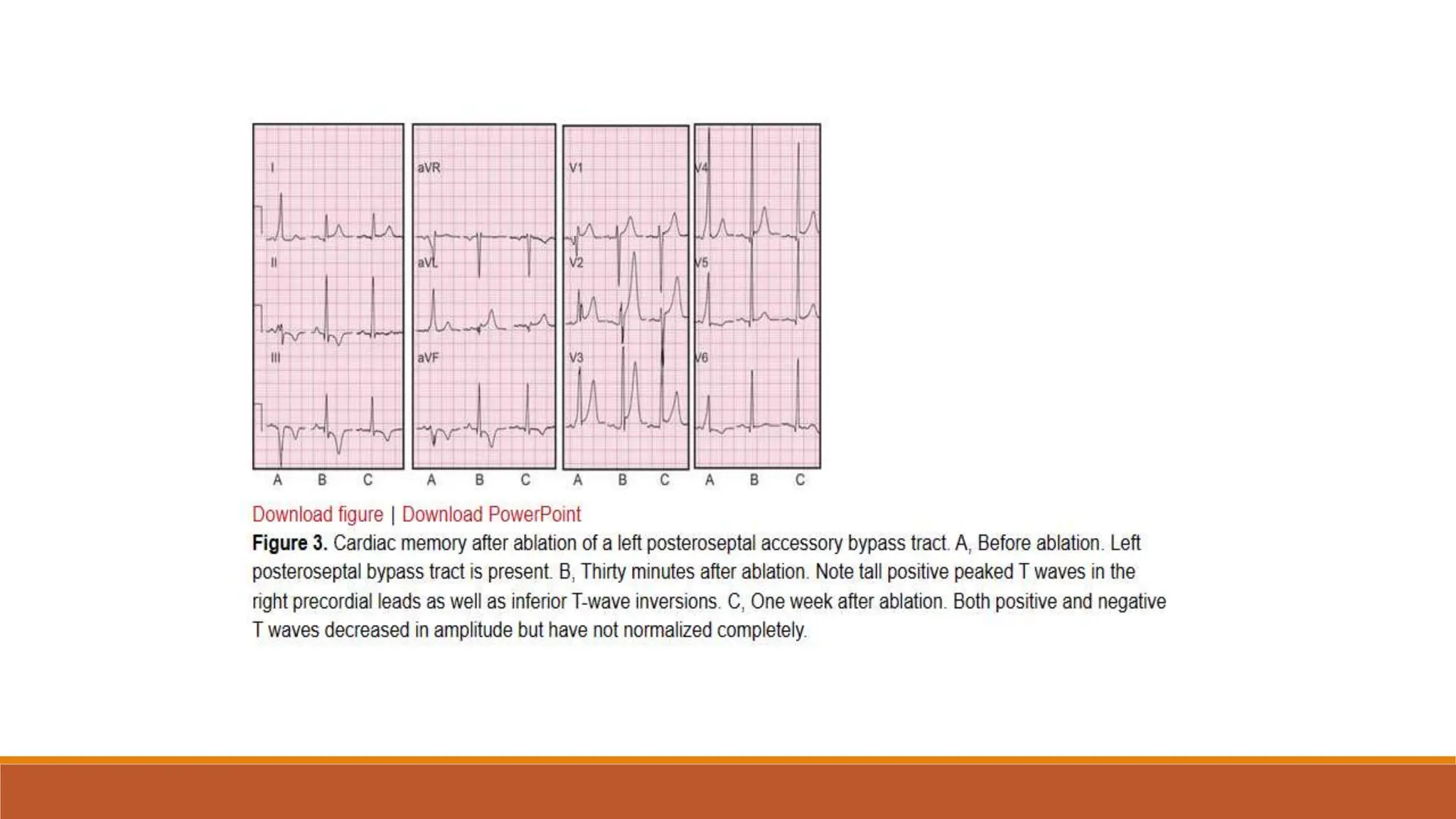 Memory T waves on EKG: pathogenesis and evaluation | PPTX