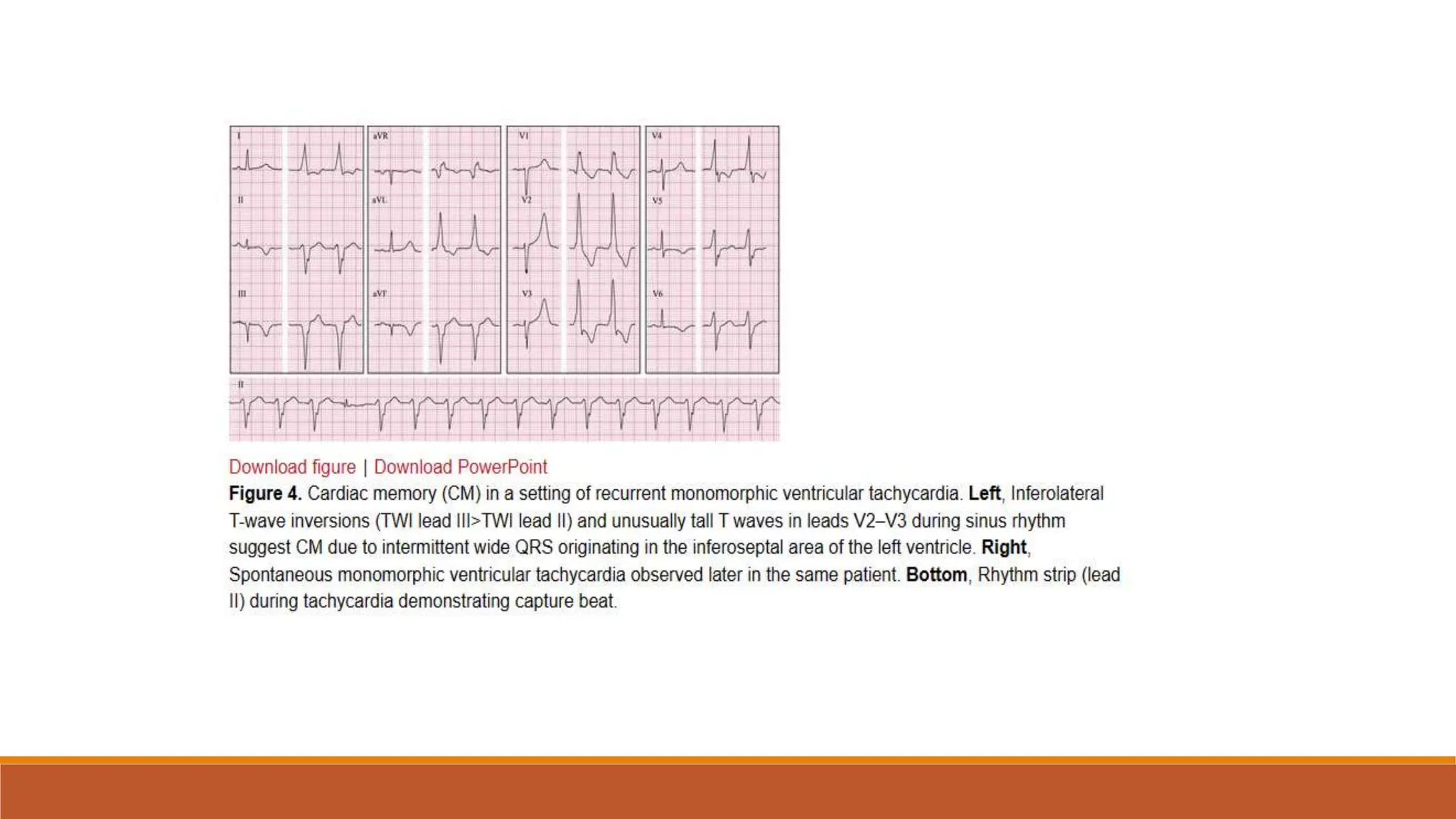 Memory T waves on EKG: pathogenesis and evaluation | PPTX