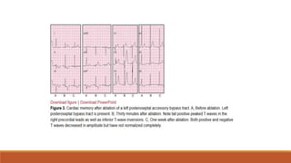 Memory T waves on EKG: pathogenesis and evaluation | PPTX | Heart and Cardiovascular Diseases ...