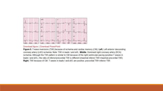 Memory T waves on EKG: pathogenesis and evaluation | PPTX | Heart and ...