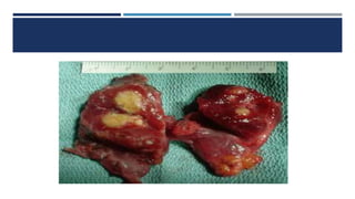 multiple endocrine neoplasia type 2 | PPTX | Thyroid Disorders ...
