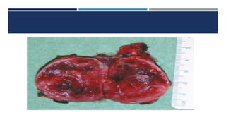 multiple endocrine neoplasia type 2 | PPTX | Thyroid Disorders ...