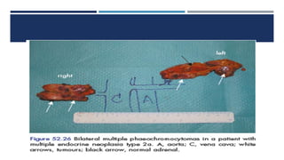 multiple endocrine neoplasia type 2 | PPTX | Thyroid Disorders ...