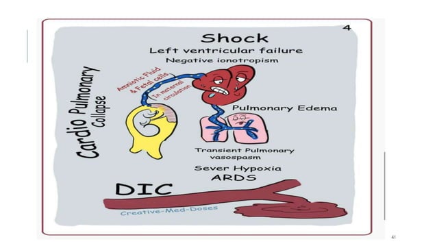 Mendelson syndrome,Amniotic fluid embolism,HELLP syndrome | PPTX | Lung ...