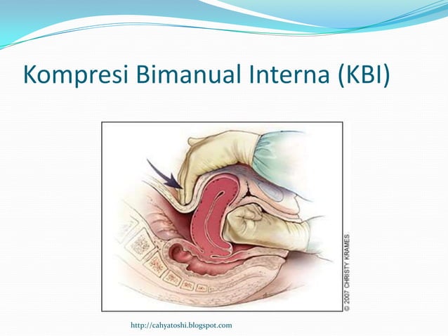 Mendeteksi komplikasi persalinan kala iii | PPTX