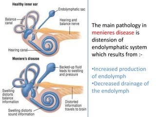 Meneieres disease | PPTX