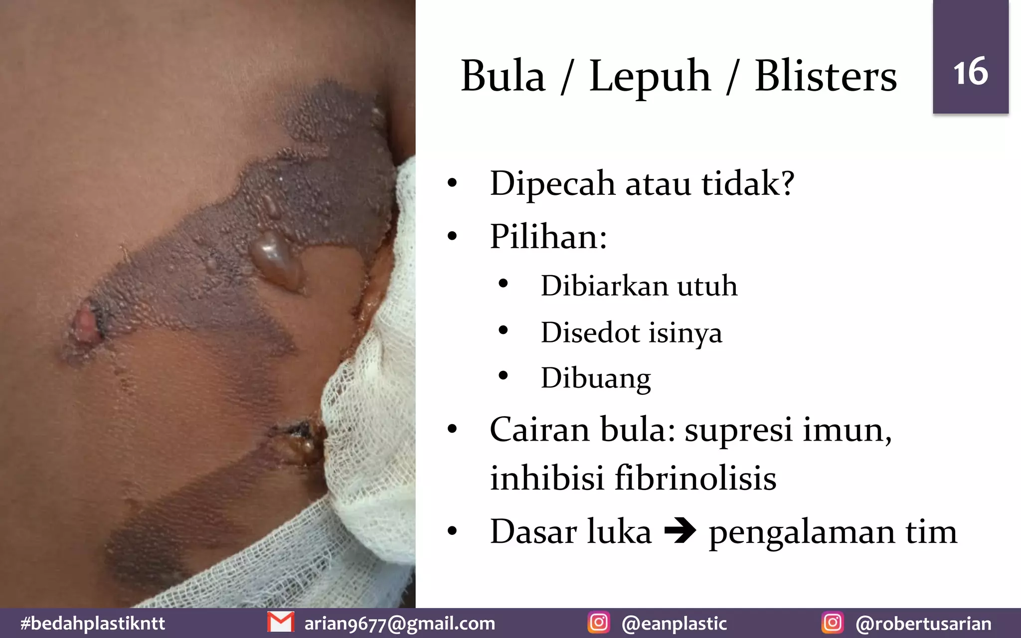 Mengelola Luka Bakar di Pelayanan Primer | PDF