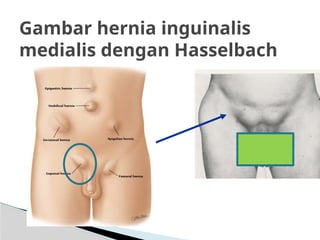 MENGENAL HERNIMengenal hernia dan waspada penyakitnya.pptx