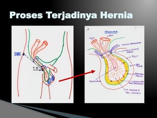 MENGENAL HERNIMengenal hernia dan waspada penyakitnya.pptx