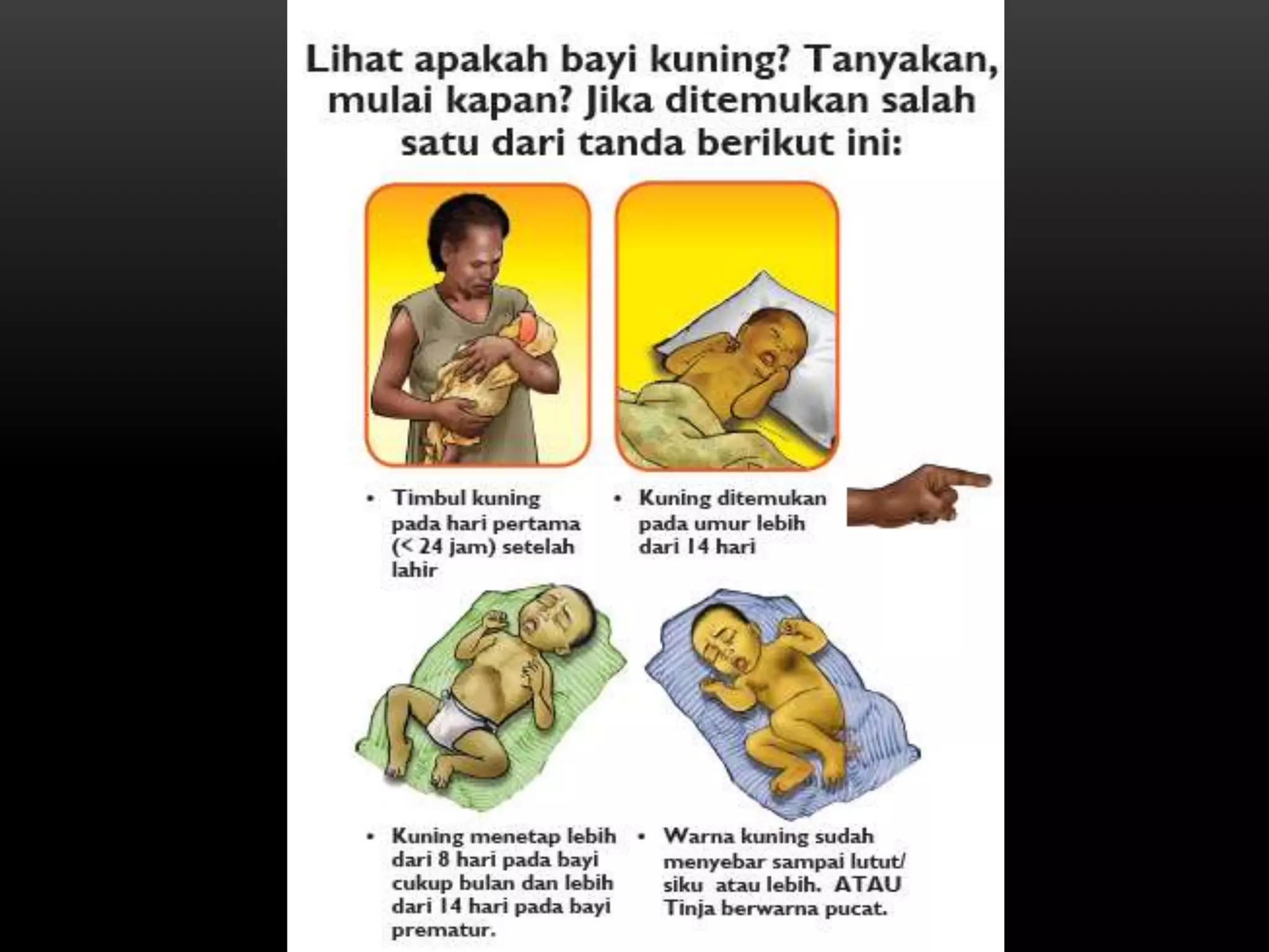 Mengenali bayi kuning dan penanganannya | PPTX