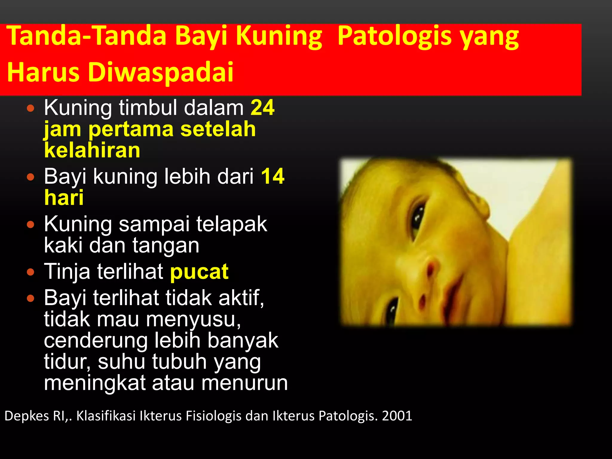 Mengenali bayi kuning dan penanganannya | PPTX