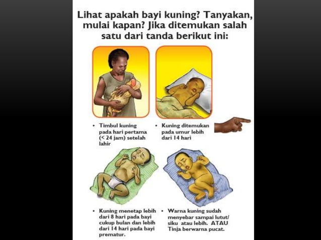 Mengenali bayi kuning dan penanganannya | PPTX