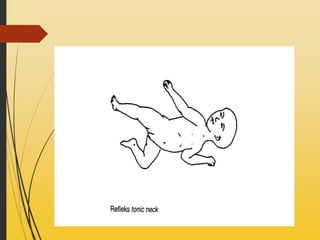 Mengenal refleks-refleks fisiologis primitif pada bayi baru 2019 (1).pptx