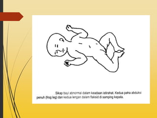 Mengenal refleks-refleks fisiologis primitif pada bayi baru 2019 (1).pptx