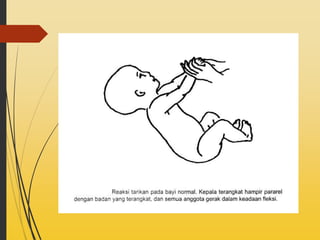 Mengenal refleks-refleks fisiologis primitif pada bayi baru 2019 (1).pptx