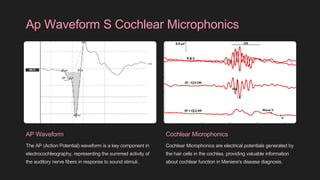 COMPREHENSIVE ANALYSIS OF Menieres-Disease.pptx