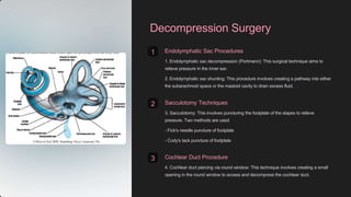 COMPREHENSIVE ANALYSIS OF Menieres-Disease.pptx