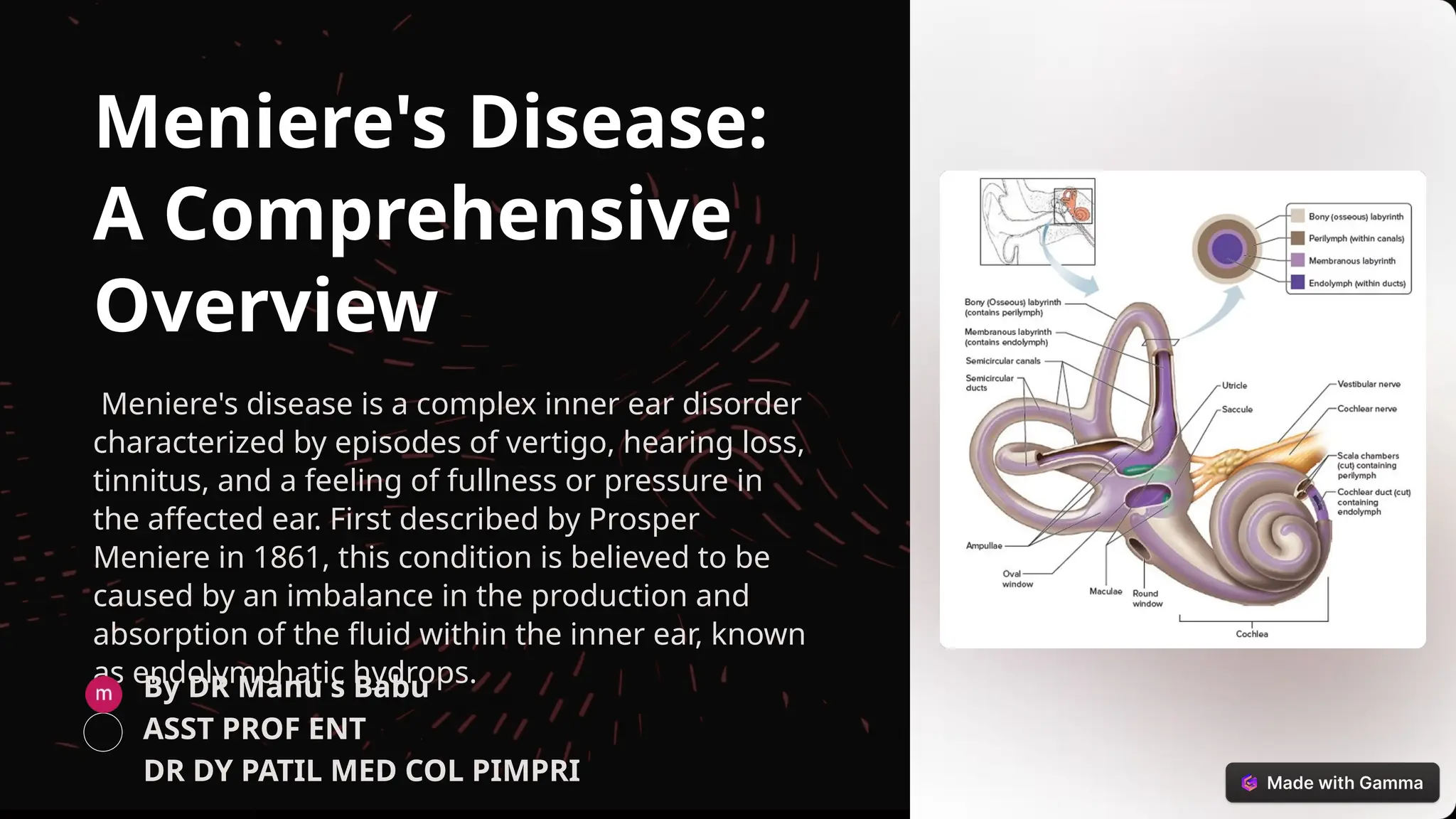 Menieres-Disease-A-Comprehensive-Overview.pptx