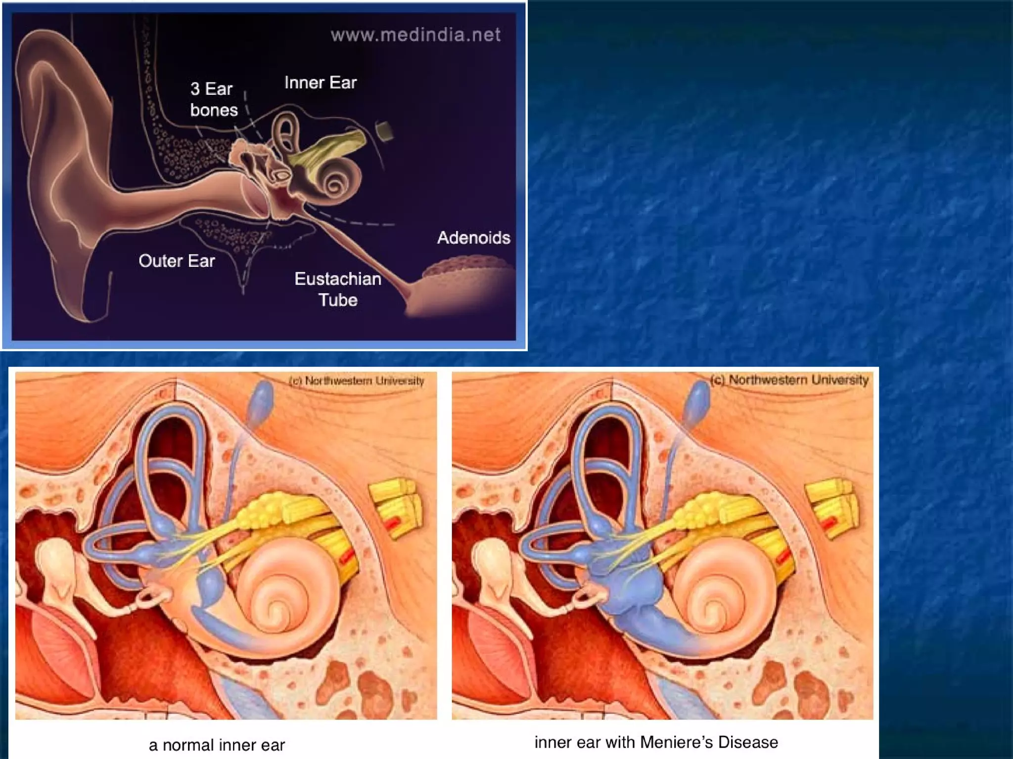 Meniere’s disease | PPT