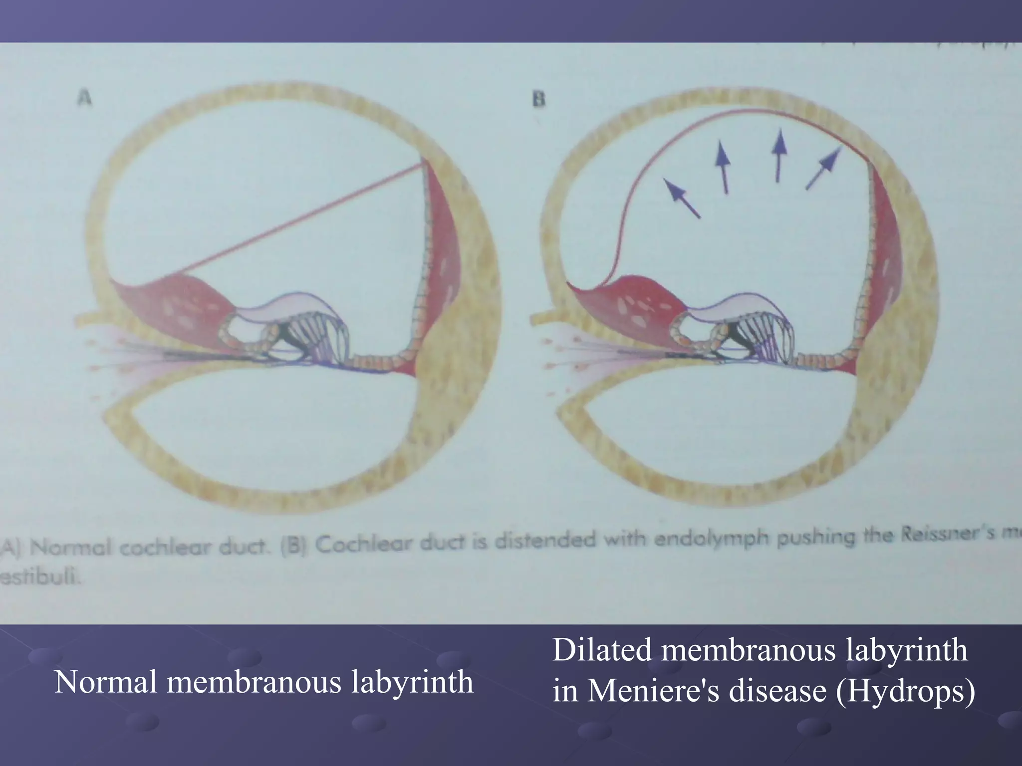 Meniere’s disease | PPT