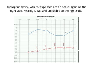 Meniere's disease | PPT