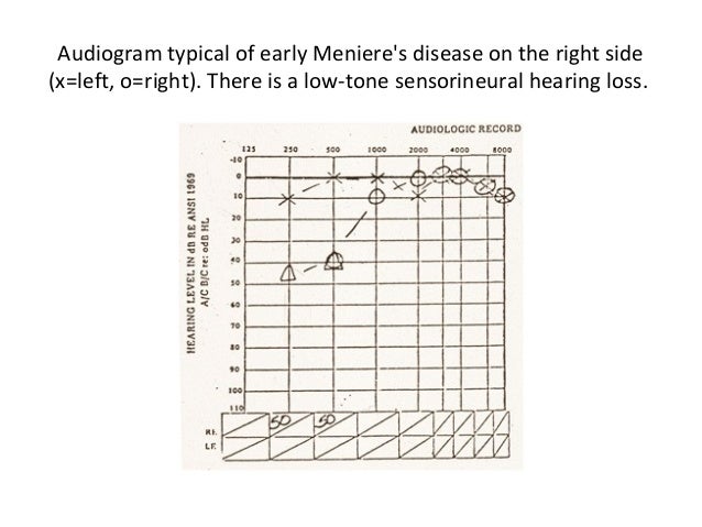 Meniere's disease