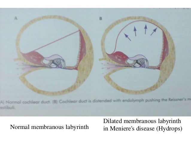 Endolymphatic Hydrops