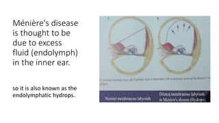 Meniere's disease by Sunil Kumar Daha | PPT