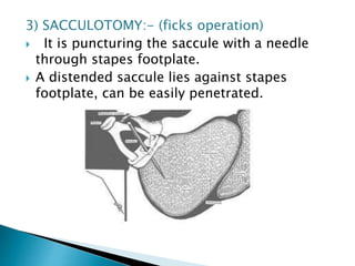 Meniere's disease | PPT