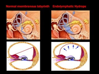 Meniere's disease | PPT