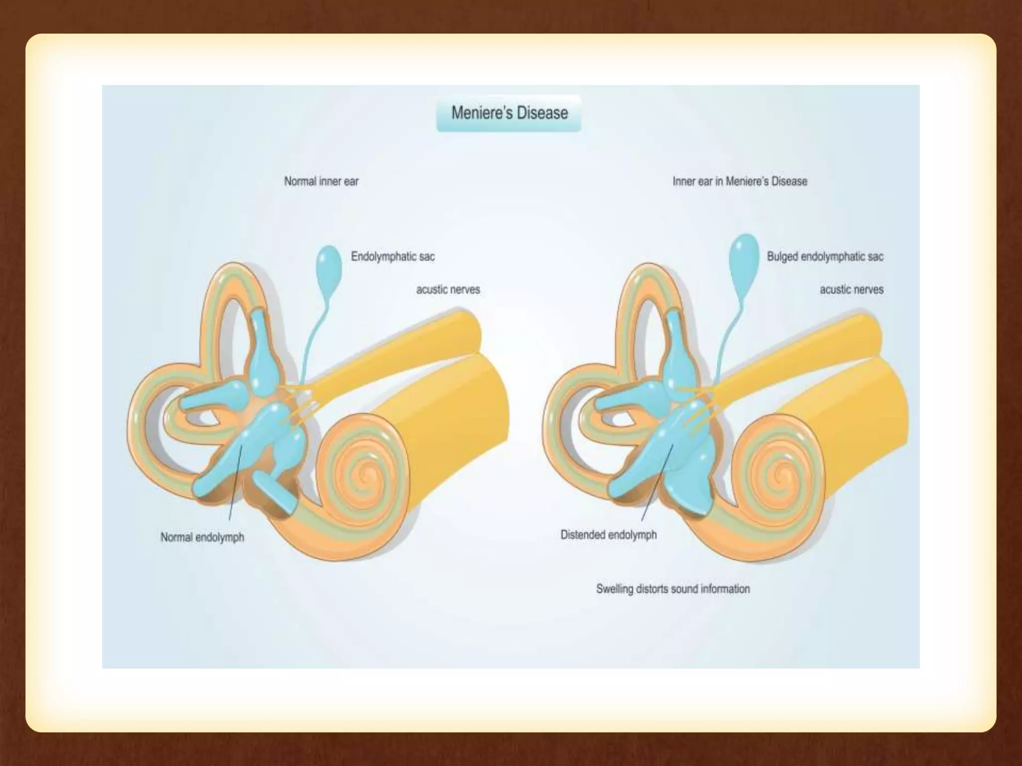 Meniere's disease | PPTX