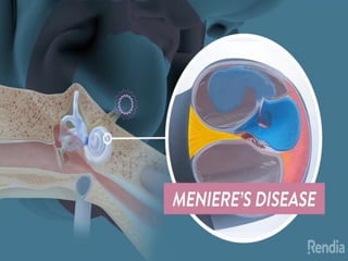 MENIERES DISEASE. | PDF | Thyroid Disorders | Endocrine and Metabolic ...