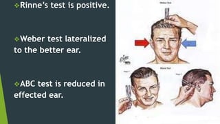 Meniere’s Disease.pptx