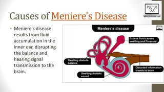 Meniere’s Disease.pdf