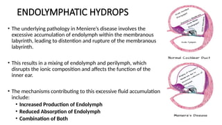 Meniere's Disease- Detailed Information.pptx