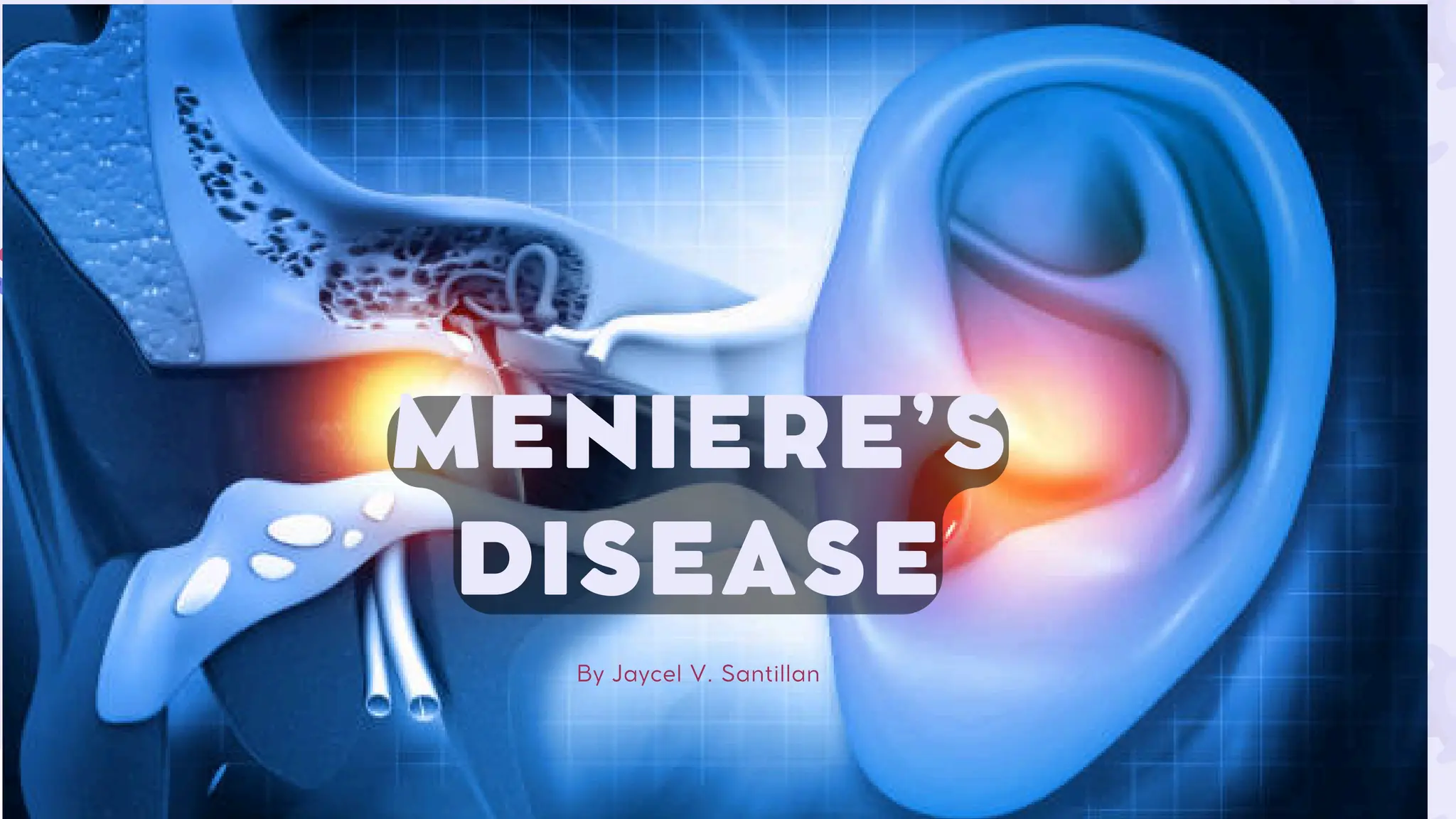 Medical Surgical Nursing - Meniere's Disease | PDF