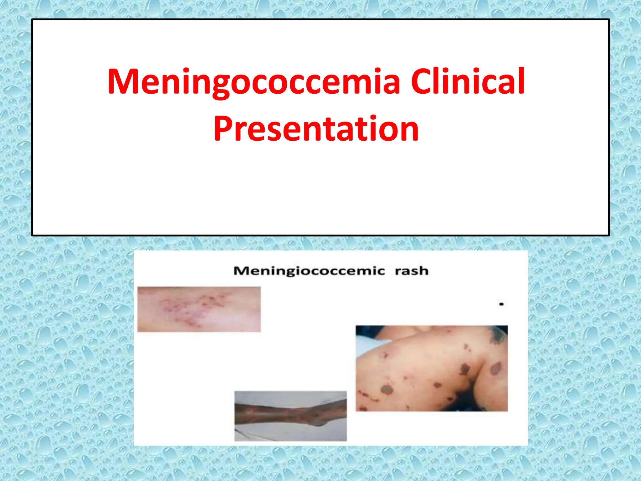update in meningeococcemia 2024 for pediatric and infectious diseases ...