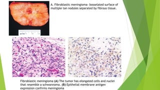 Meninges and related tumors | PPTX
