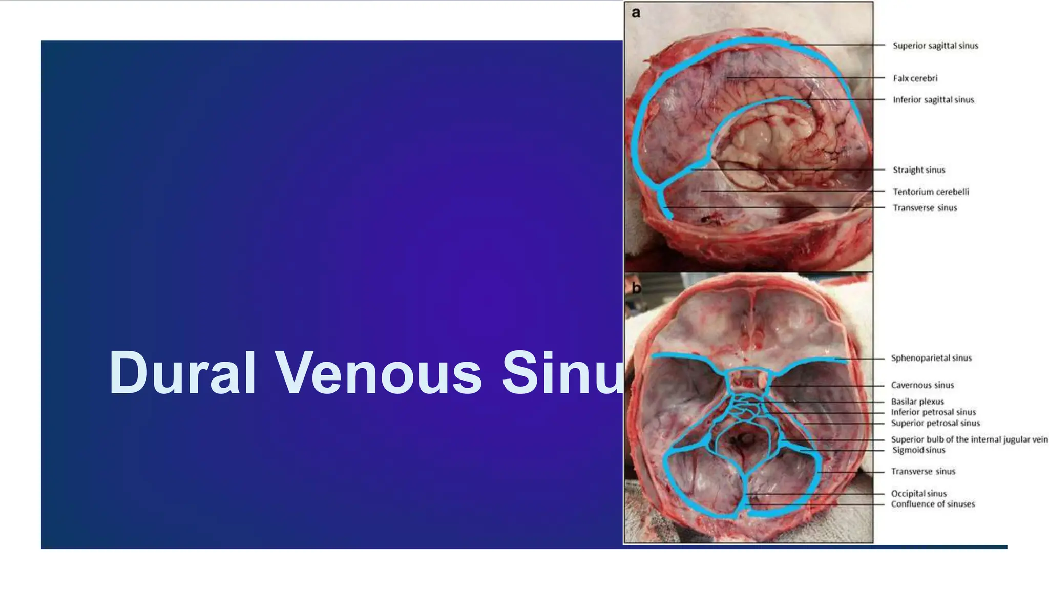 Meninges of Brain & Spinal Cord AnD Dura Venous Sinuses .pptx