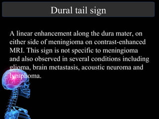 Imaging of Intracranial Meningioma | PPT