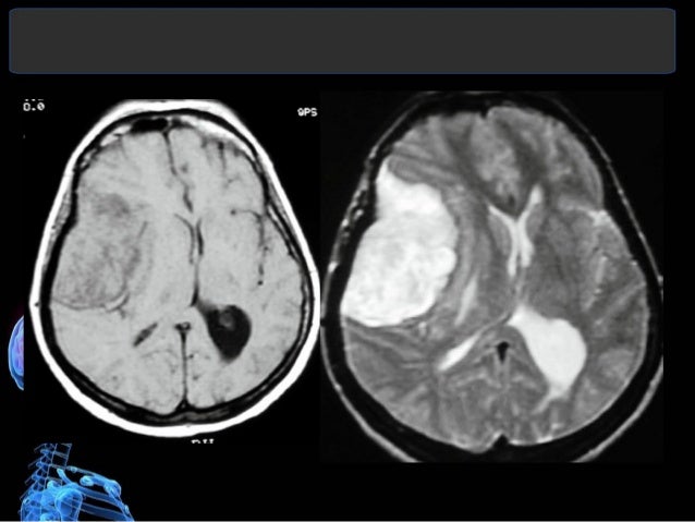 Imaging of Intracranial Meningioma