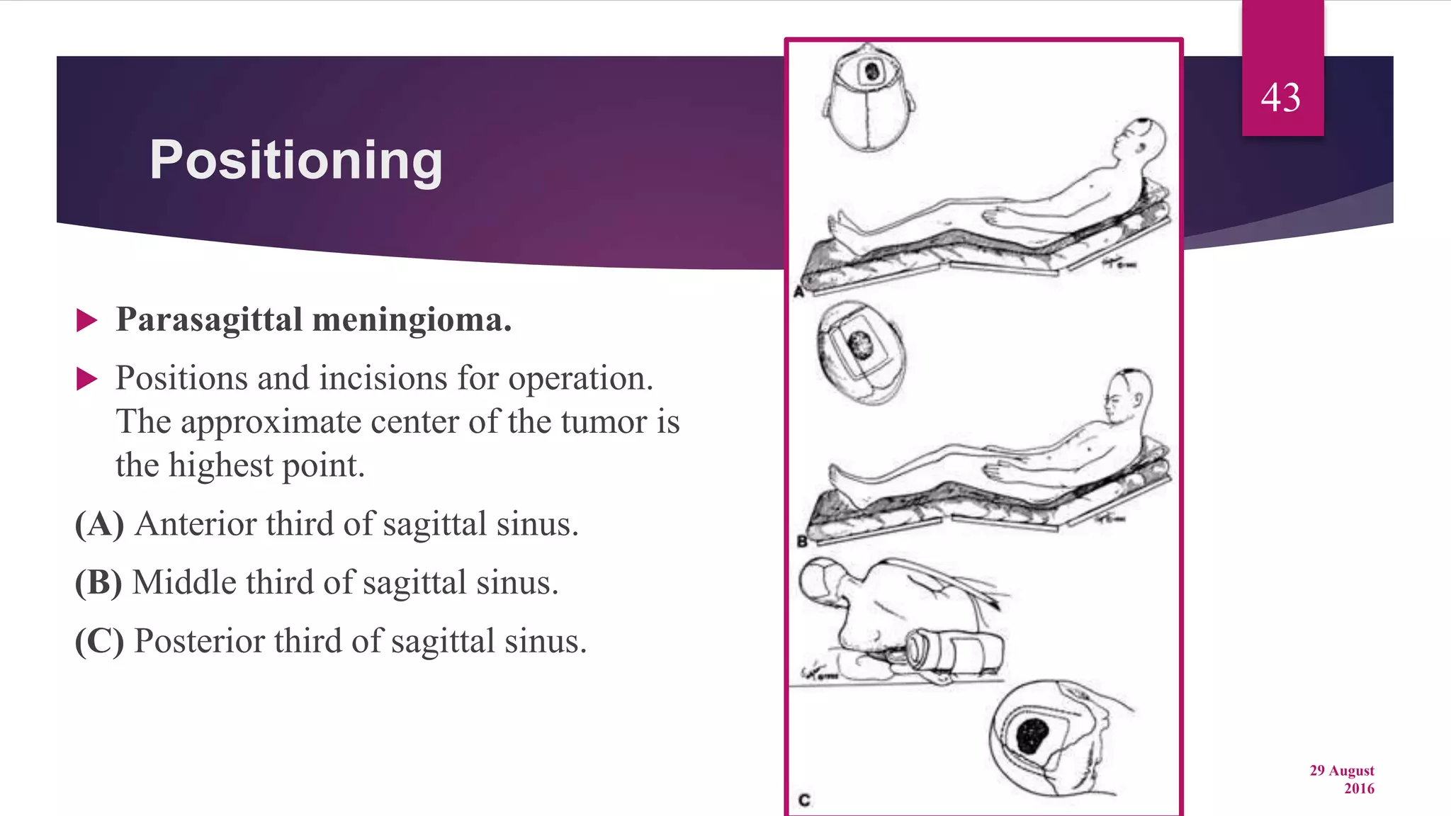 Meningioma falcine and parasagittal | PPTX