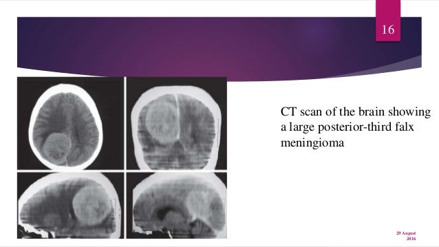 Meningioma falcine and parasagittal