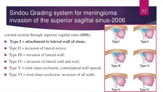 Meningioma falcine and parasagittal