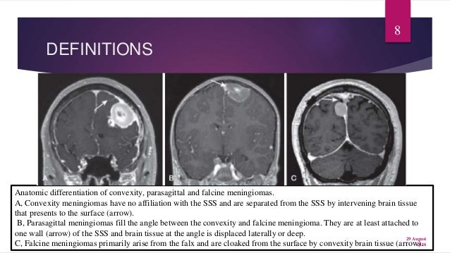 Meningioma falcine and parasagittal