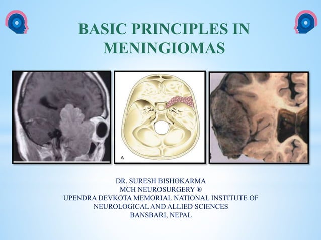 Meningioma of brain | PPTX